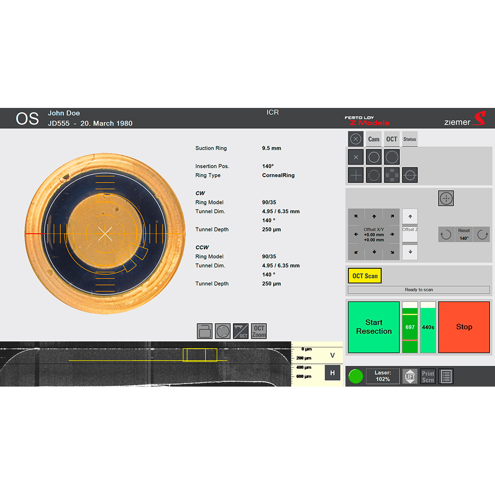 Tunnels for Intracorneal Rings / Ziemer Ophthalmic Systems AG